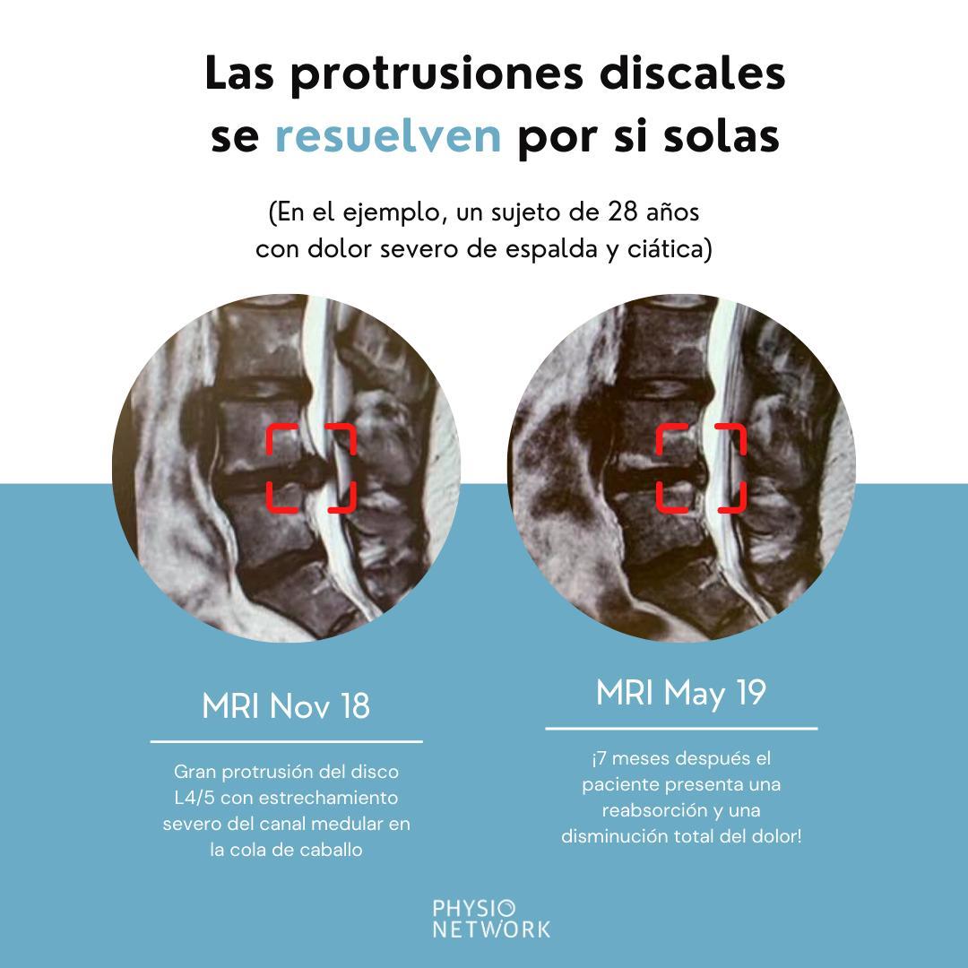 Las protrusiones discales se resuelven solas - Physio Network