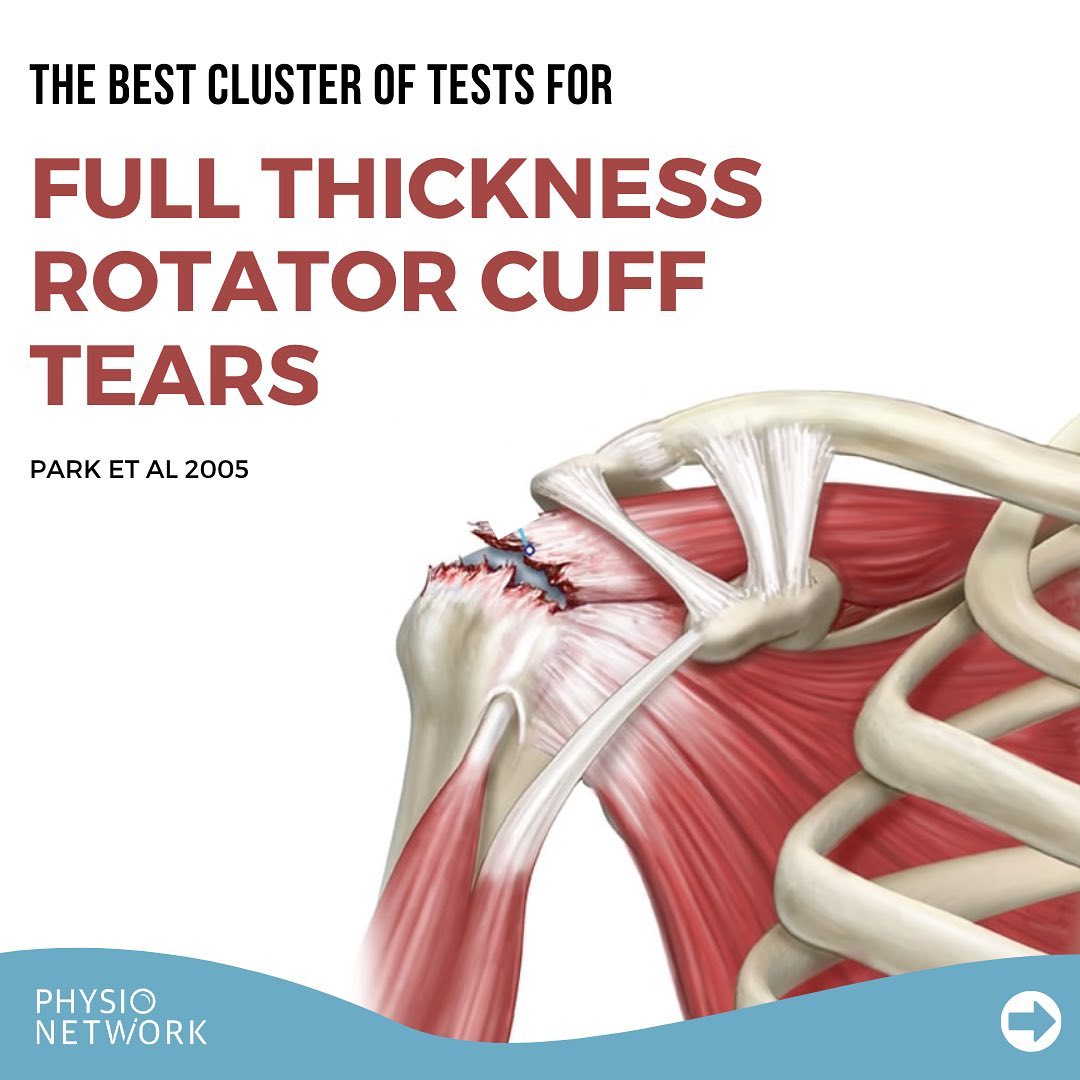 Here's The Best Cluster Of Tests For Full Thickness Rotator Cuff Tears ...