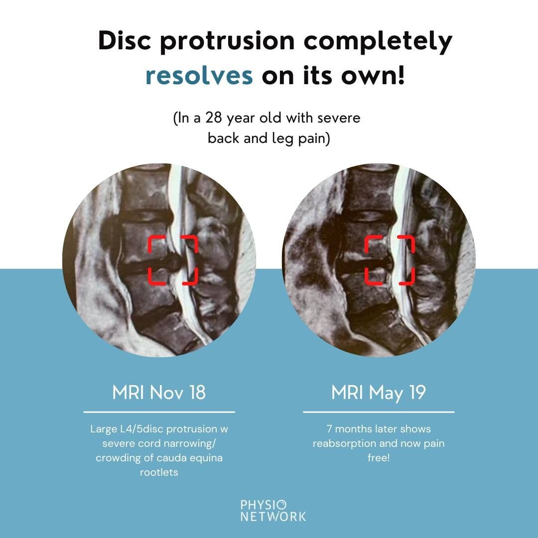 Disc Protrusion Completely Resolves On Its Own — Physio Network