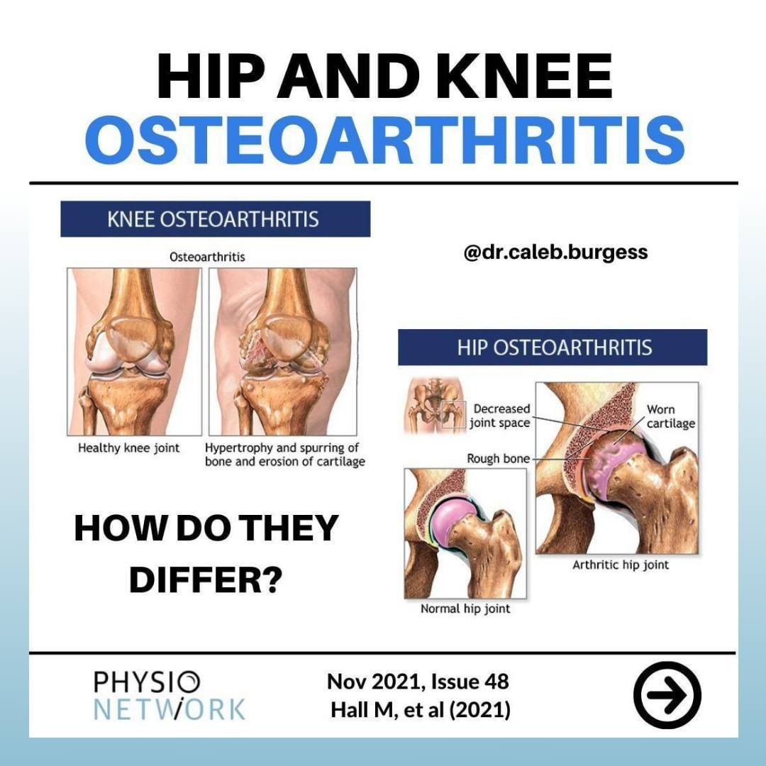 💥 Hip And Knee Osteoarthritis — Physio Network