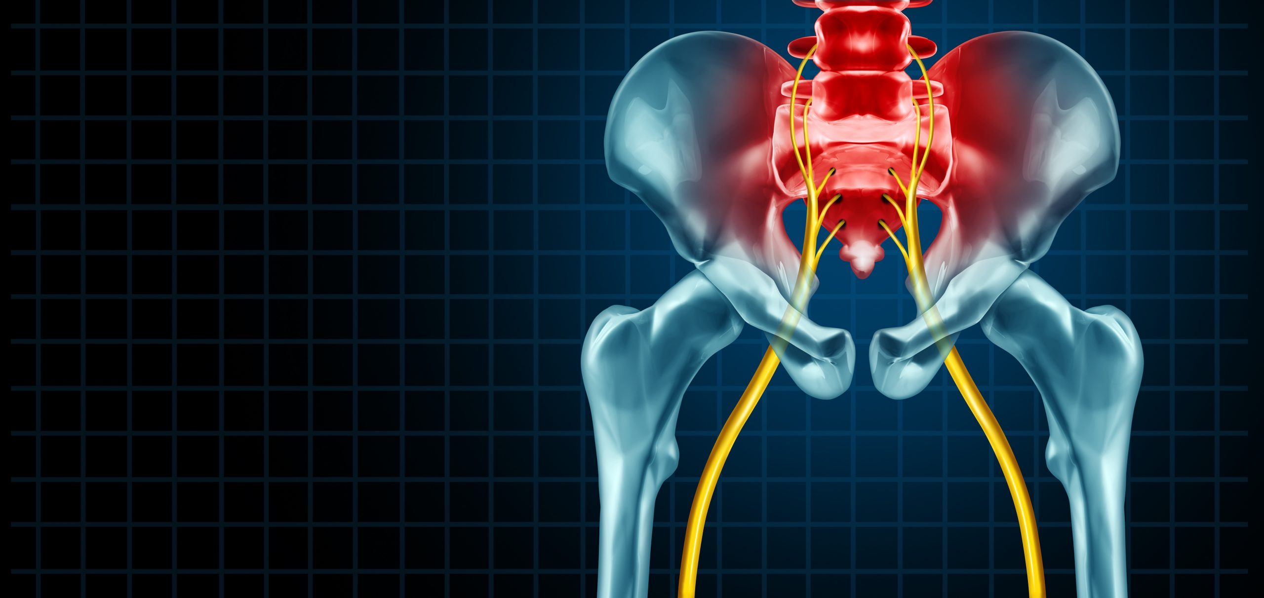 6 Tell-Tale Signs Your Patient Has Sciatica - Physio Network