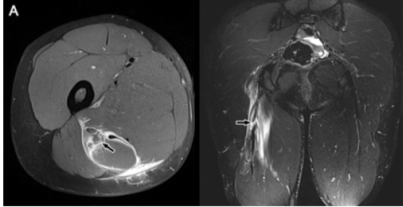 Intramuscular Tendon Injuries…..A Cause For Concern In Hamstring ...