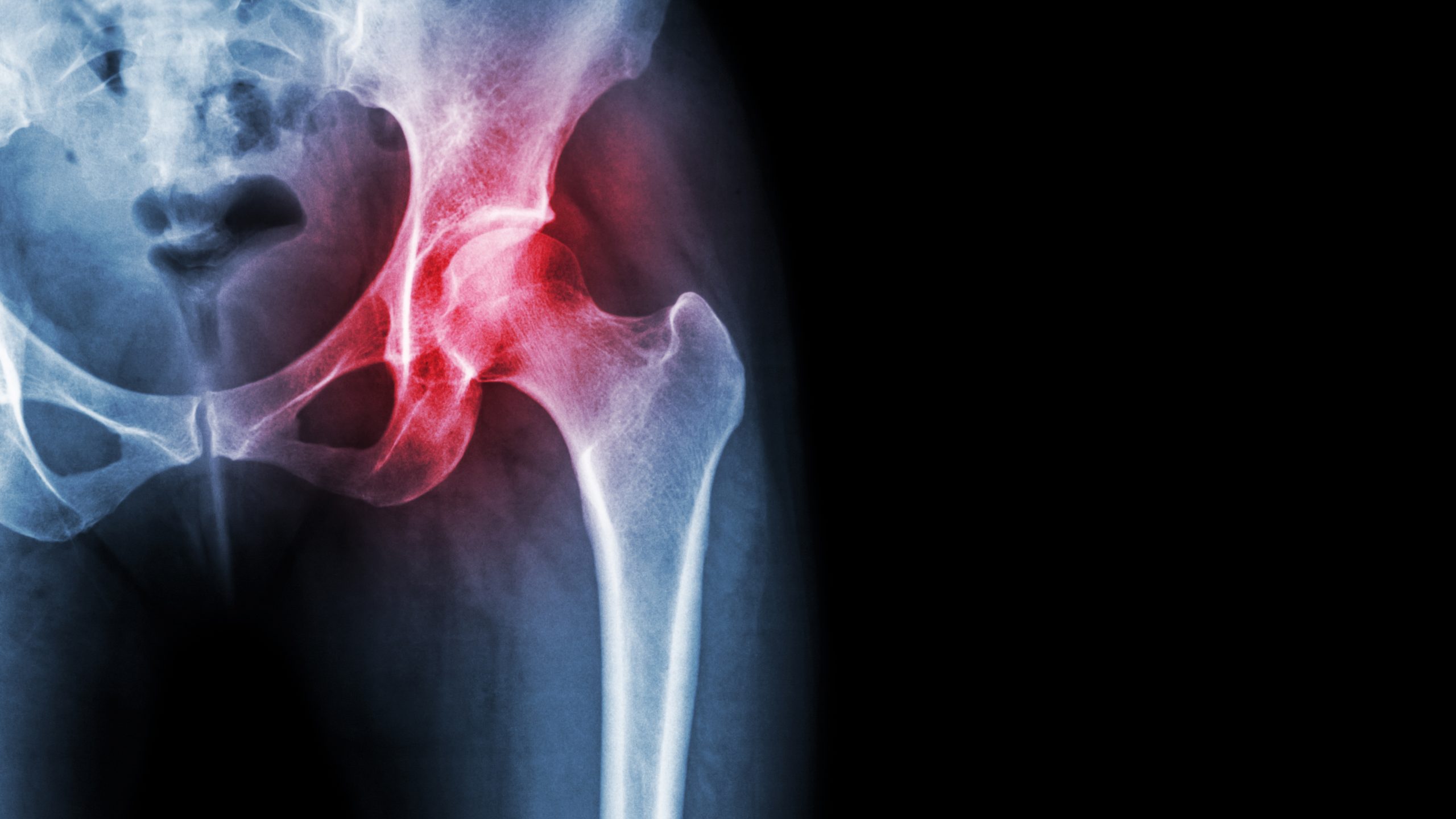 5 Methods to Manage Hip Osteoarthritis - Physio Network