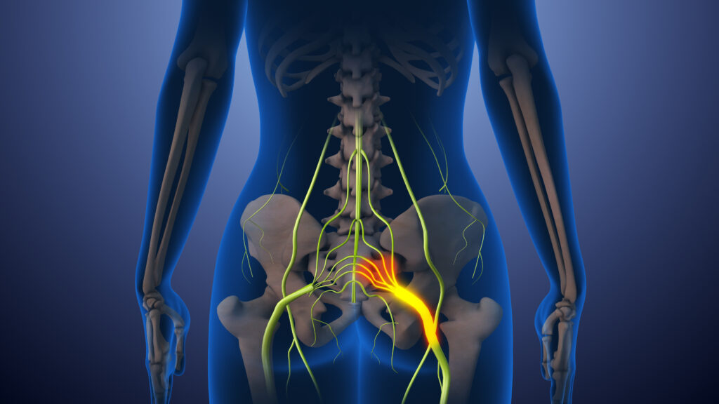 Are You Sure It’s “Just Sciatica”? Expert Case Study Insights — Physio Network