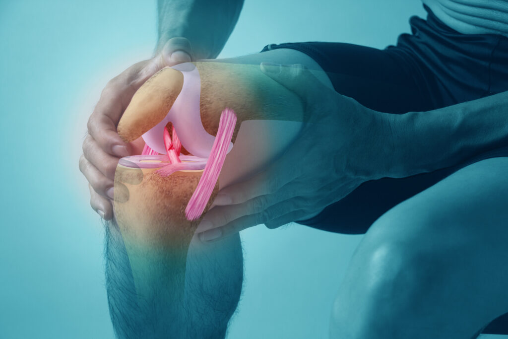 ACL Cross Bracing Protocol: Key Patient Selection Factors For Physios ...